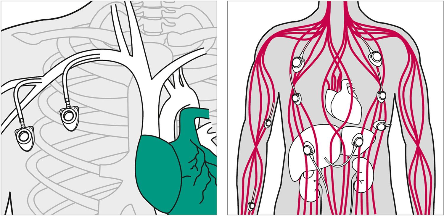 Ports and needles for vascular access - B. Braun