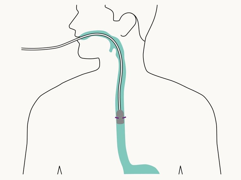 Eso-SPONGE® endoluminal vacuum therapy in the upper GI tract - B. Braun