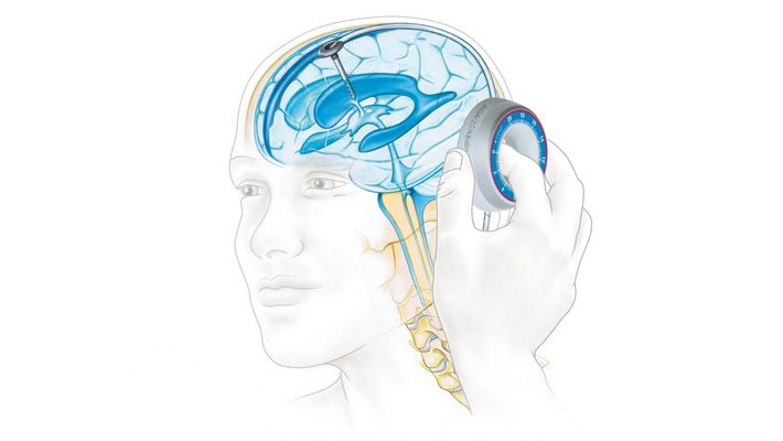 Understanding Hydrocephalus - B. Braun