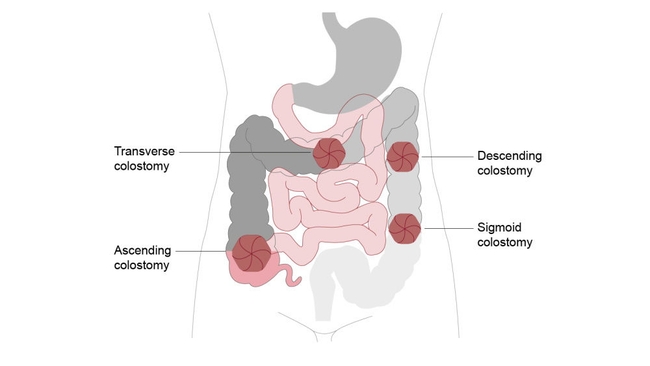 What is a Stoma? Stoma Function and Types Explained - B. Braun