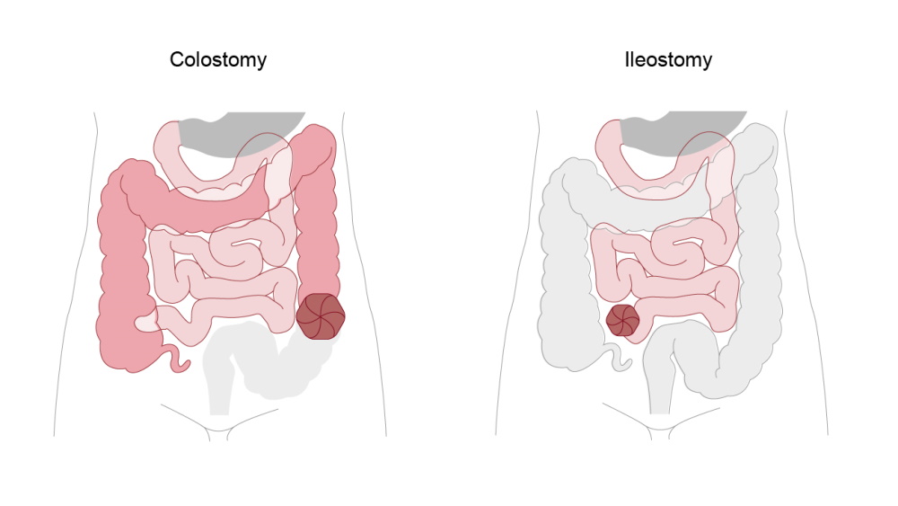 What is a Stoma? Stoma Function and Types Explained - B. Braun