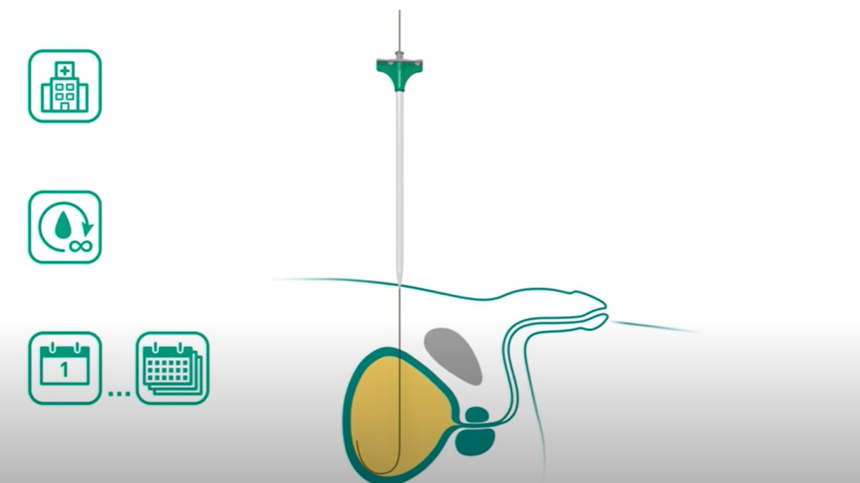 Urinary Catheterization: Three Methods of Bladder Emptying - B. Braun