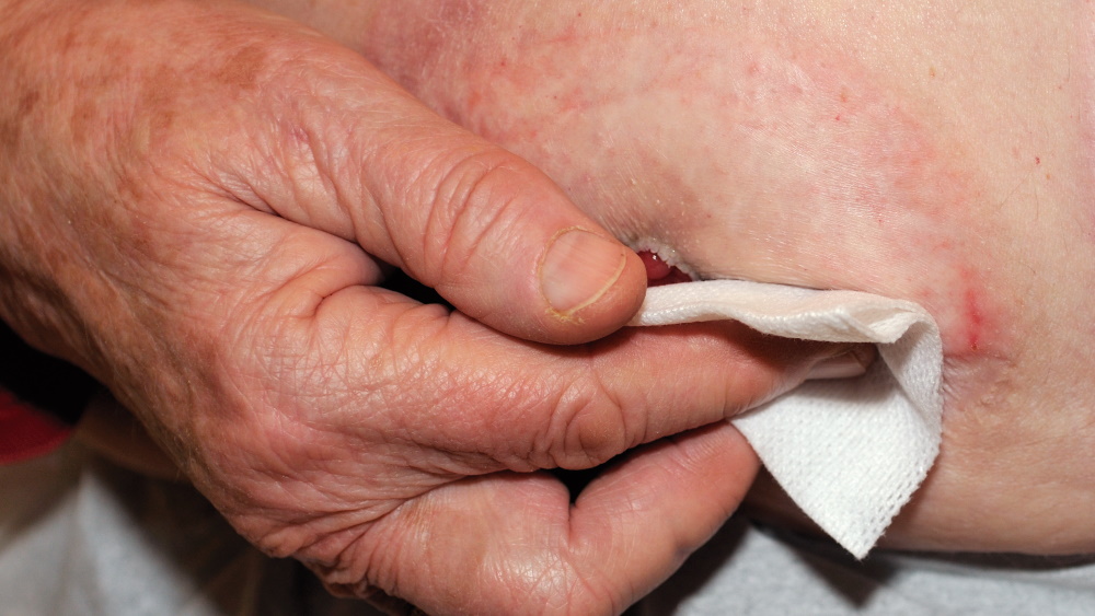 Skin Irritation Around Your Stoma: Tips to Help Avoid it - B. Braun